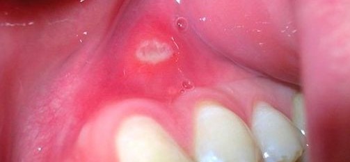 ¿Qué son las aftas? - CLINICA ROSTIROLLA